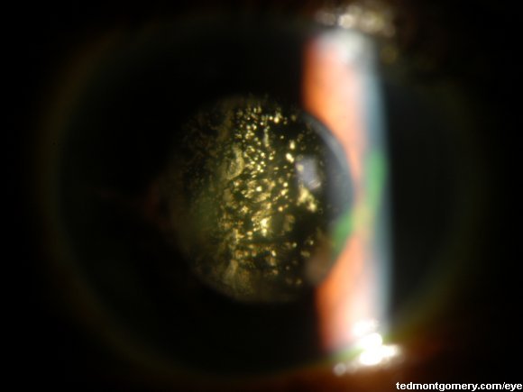 Asteroid Hyalosis: #1