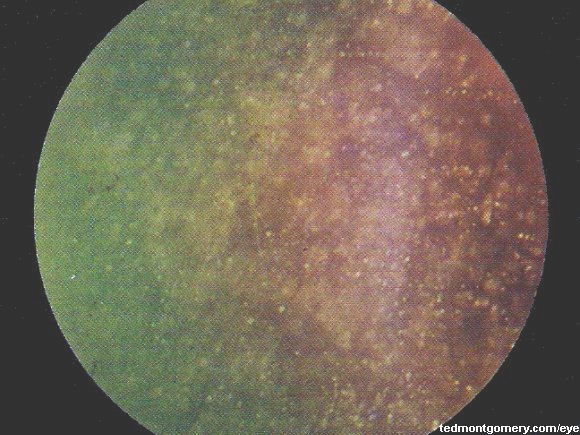 Asteroid Hyalosis: #2