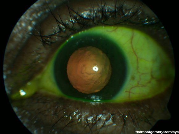 Posterior Subcapsular Cataract: #1