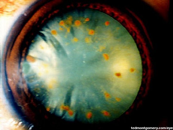 Cataract with Uveitis