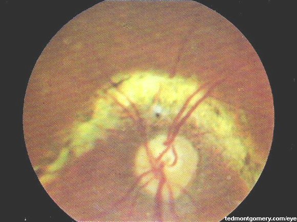 Choroidal Rupture