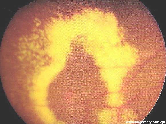 Circinate Retinopathy