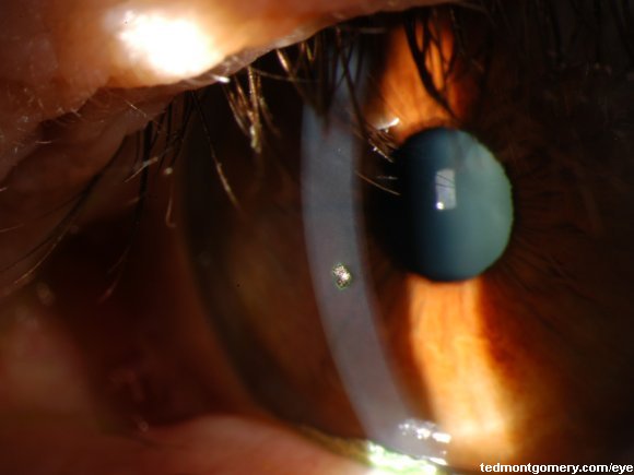 Corneal Foreign Body: #2