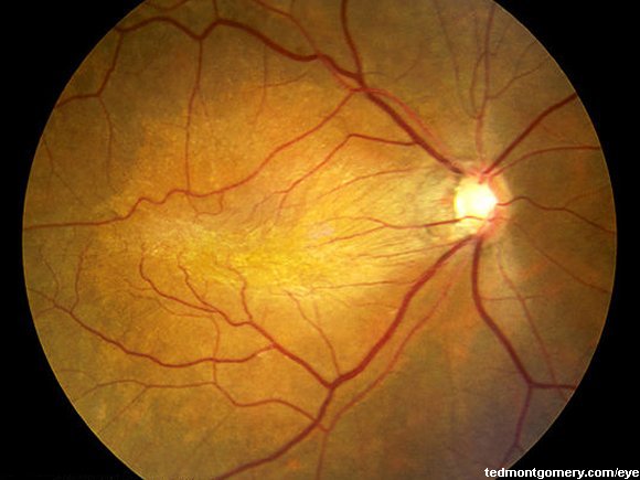 Epiretinal Membrane: #1