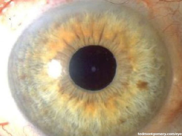 Intraocular Lens (IOL), Posterior Chamber