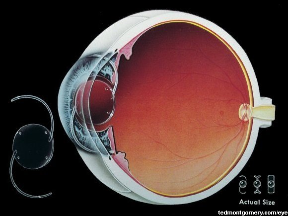 Intraocular Lens