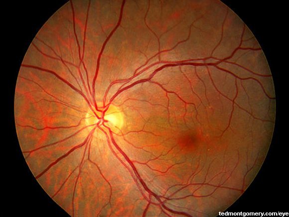 Normal Fundus (Tessellated): #3