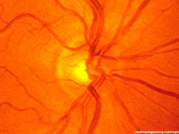 Normal Optic Disk: #1