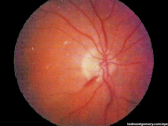 Optic Nerve Head Hemorrhage