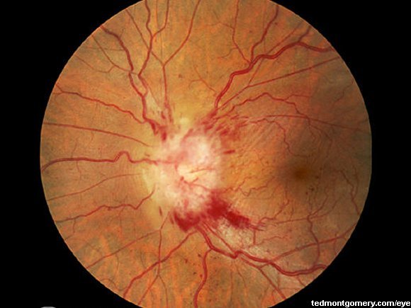Papilledema; Choked Disk; Optic Papilla Edema; Optic Disk Edema ...