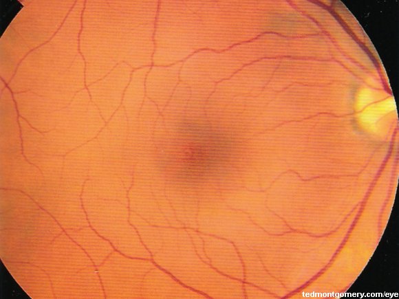 Normal Retina (Caucasian)