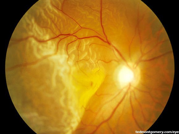 Retinal Detachment: #1