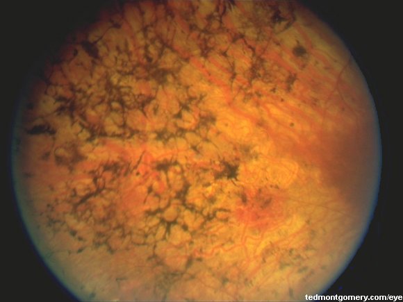 Retinitis pigmentosa; Retinopatía Pigmentaria; Distrofia de Bastones y ...