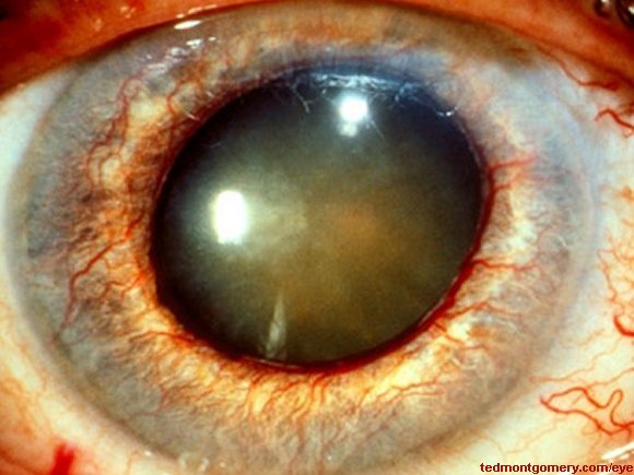 Diabetic Rubeosis Face