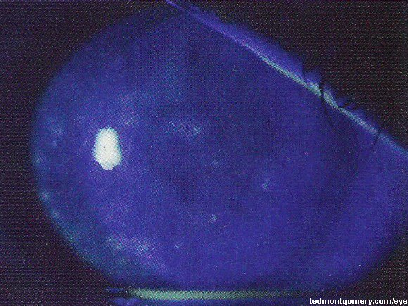 Thygeson's Keratopathy